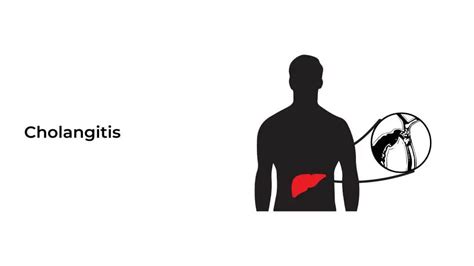 Cholangitis ~ Healthcare City
