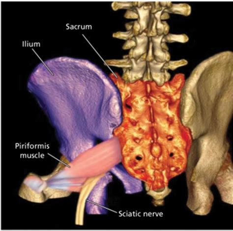 Complications Of Trigger Point Injection Anesthesia Key