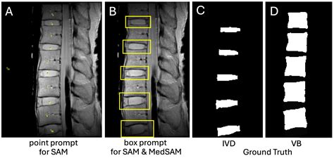 Segment Anything Model Sam And Medical Sam Medsam For Lumbar Spine Mri