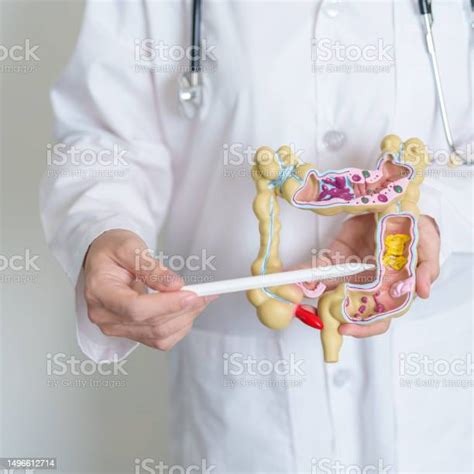 인간 결장 해부학 모델을 들고 있는 의사 대장 질환 대장 대장암 궤양성 대장염 게실염 과민성 대장 증후군 소화기 계통 및 건강 개념 위장염에 대한 스톡 사진 및 기타 이미지