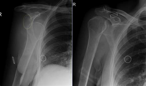 Anterior Shoulder Dislocation Radiology At St Vincents University