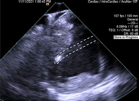 Intra Cardiac Echocardiography Performed At The Time Of Left