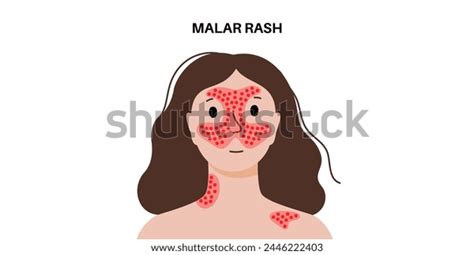 Systemic Lupus Erythematosus Medical Poster Butterfly Stock Vector