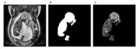 Preprocessing Steps To Obtain The Fetal Segmentation A Represents