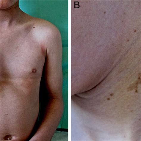 Patient 2 A Pectus Excavatum A Skeletal Abnormality That Is Common Download Scientific