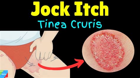 Jock Itch Tinea Cruris Skin Disorders Symptoms Mycoses Of The Skin