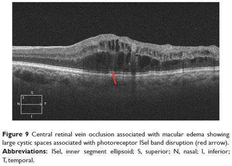photoreceptor inner segment ellipsoid band integrity on spectral domai