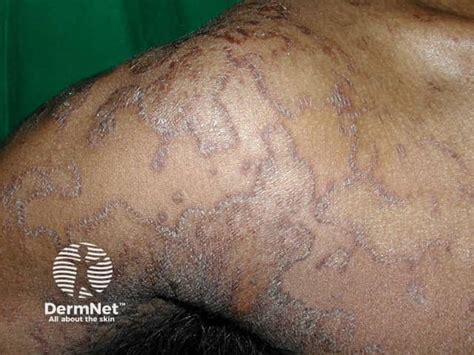 Erythrokeratodermia Variabilis Erythrokeratoderma Variabilis In A