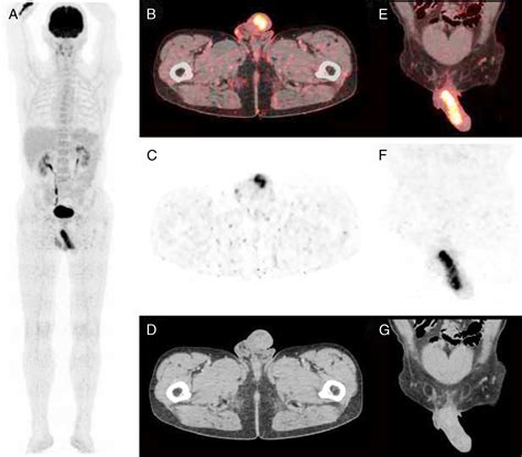 Corpus Cavernosum Abscess Diagnosed On Fdg Petct Clinical Nuclear