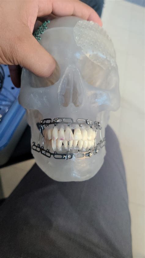 Fractura Maxilar Y Dentoalveolar Cirugiaoralymaxilofacial