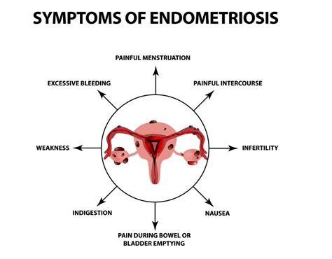 Most Commonly Asked Questions About Fibroids Endometriosis And PCOS