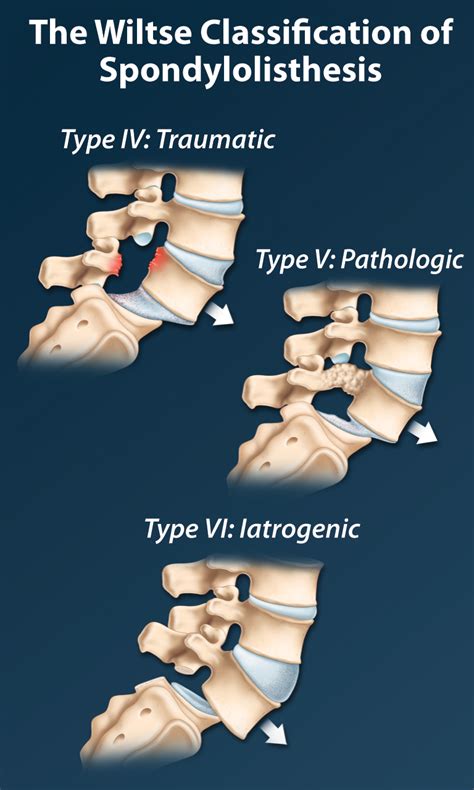 The Types And Treatments Of Spondylolisthesis