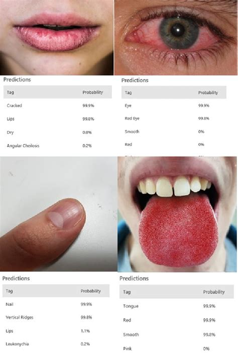 Figure 1 From Vitamin Deficiency Detection Using Image Processing And