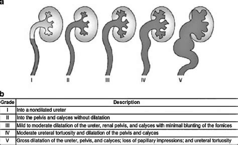 Vesicoureteral Reflux Causes Grading Symptoms Diagnosis And Treatment
