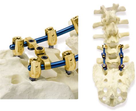 Columna Vertebral - Endo Médica Inversiones