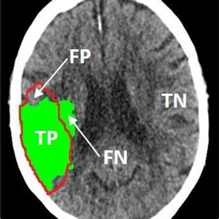An Example Lesion Summary Map The Red Border Indicates The Lesion Download Scientific Diagram
