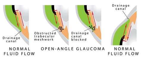 Angle Closure Glaucoma Vs Open Angle