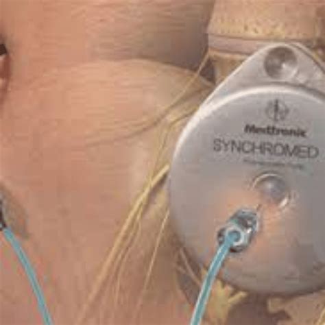 Intrathecal Pump Implantation Doctor Pune Dr Deshmukhs Pain Clinic Pune