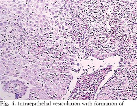 Pyostomatitis Vegetans Histology