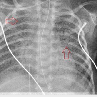 CXR From Day Of Life Show Diffuse Bilateral Reticulogranular Download Scientific Diagram