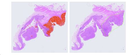 Automated Identification Of Colorectal Tumor In Hande Tissue Samples Download Scientific Automated Identification Of Colorectal Tumor In Hande Tissue Samples Download Scientific