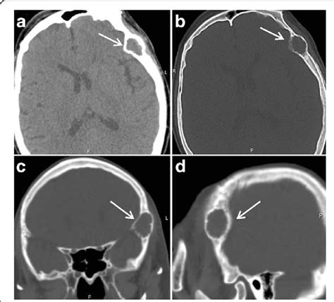 A And B Shows Presurgical Cranial Computed Tomography Revealed A Download Scientific Diagram