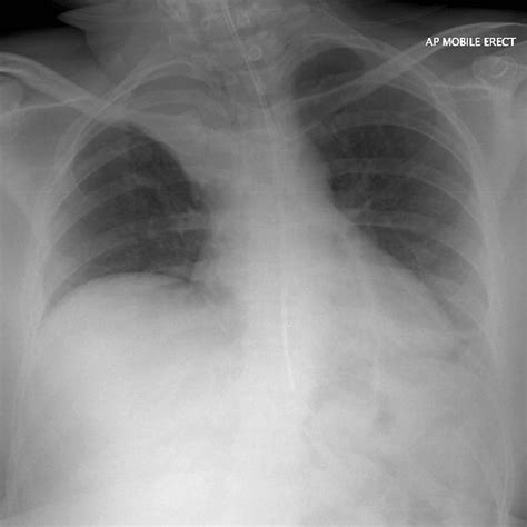 Atelectasis Pulmonary Medbullets Step 2 3