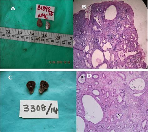 Photomicrograph Showing Juvenile Polyp And Hyperplastic Polyp A Gross Download Scientific