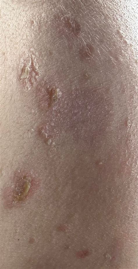 Ringworm Rdermatologyquestions