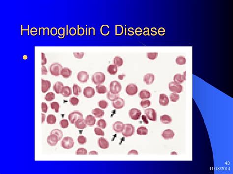 Ppt Hematology 425 Hemoglobinopathies Powerpoint Presentation Free