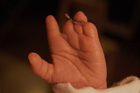 30 Facts About Lbwc Amniotic Bands