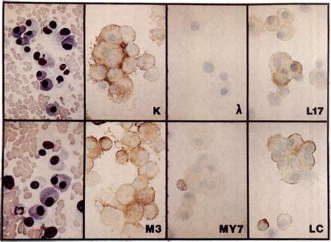 Morphologic And Phenotypic Features Case No 14 A Classic Plasma