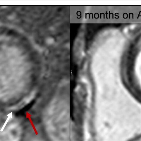 Basal Short Axis Phase Sensitive Inversion Recovery Late Gadolinium Download Scientific