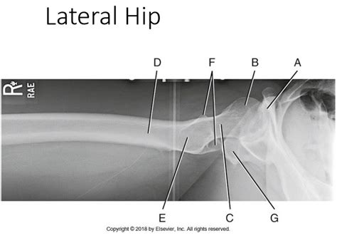 Lateral Hip Radiograph Diagram Diagram Quizlet