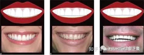 Instasmile小课堂丨拥有年轻笑容的秘密 知乎