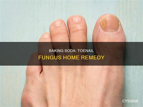 Baking Soda Toenail Fungus Home Remedy CySoda