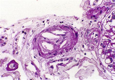 Ajkd Atlas Of Renal Pathology Cholesterol Emboli American Journal Of