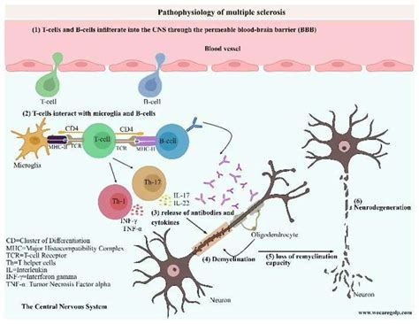 Multiple Sclerosis Ms Types Symptoms Treatment We Care