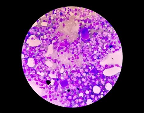 Premium Photo Bone Marrow Analysis Under Microscope With 40x