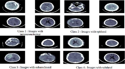 Figure 5 From Intracranial Hemorrhage Detection Using Neural Network Based Methods With