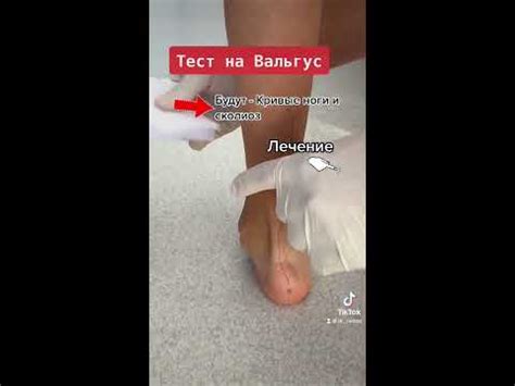 Тест на Вальгус стоп - YouTube