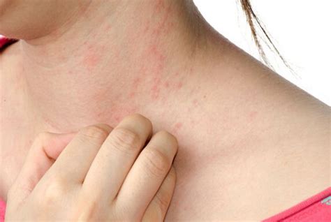 Itchy Red Bumps On Skin 12 Common Causes With Treatment