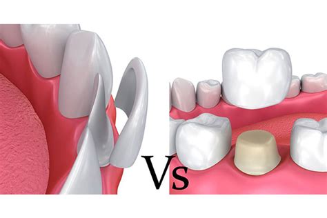 Veneers Vs Crowns Pros And Cons And Costs 2025 Guide