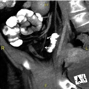 Normal Appearance Of The Appendix On CT The Normal Appendix Arrow Download Scientific