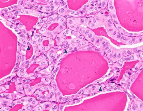 Pathology Outlines Oncocytic