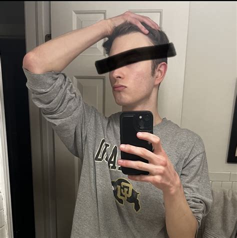 Looking For The Best Treatment To Combine With Subcision Scar