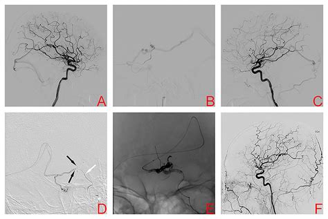 Frontiers Transvenous Embolization Of Hemorrhagic Brain Arteriovenous Malformations Case