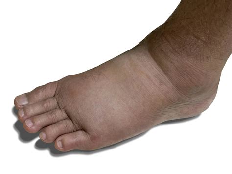 8 Ways To Avoid Swollen Feet And Ankles Precision Foot And Ankle Centers