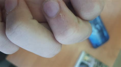 Проблема кожи на руках Вопрос дерматологу 03 Онлайн