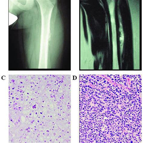 Pdf Secondary Osteosarcoma In Patients Previously Treated For